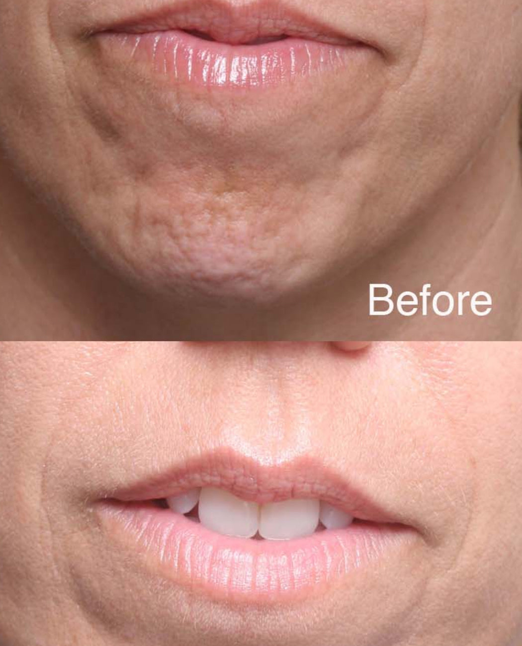 Chin Dimpling – GLAMOURGIRLSLDN